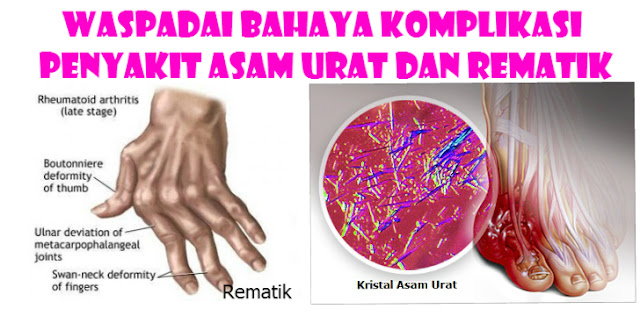 Gejala Rematik Yang Akan Terjadi Setelah Anda Melakukan Cara Ini ...