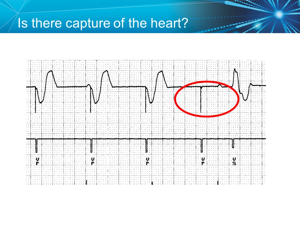 CVT Mohd Farid: Pacemaker Follow Up Part II-Medtronic Academy