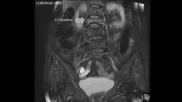 Ultimate Radiology : BENIGN VERTEBRAL COLLAPSE
