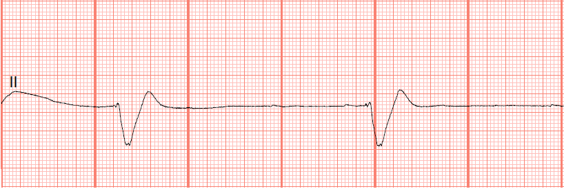 Basic EKG Rhythm Test 33