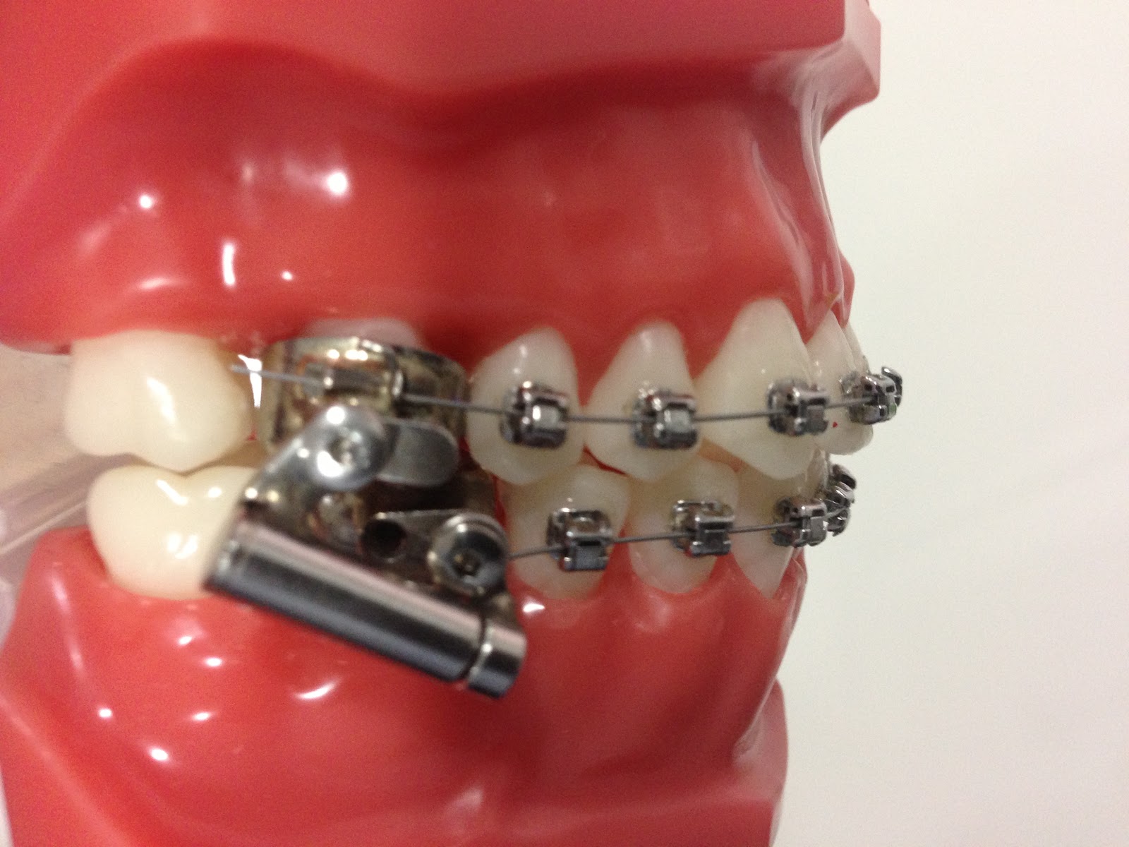 ORTODONCIA INVISIBLE HABIB BARHOUM: ADVANSYNC 2 - ORMCO