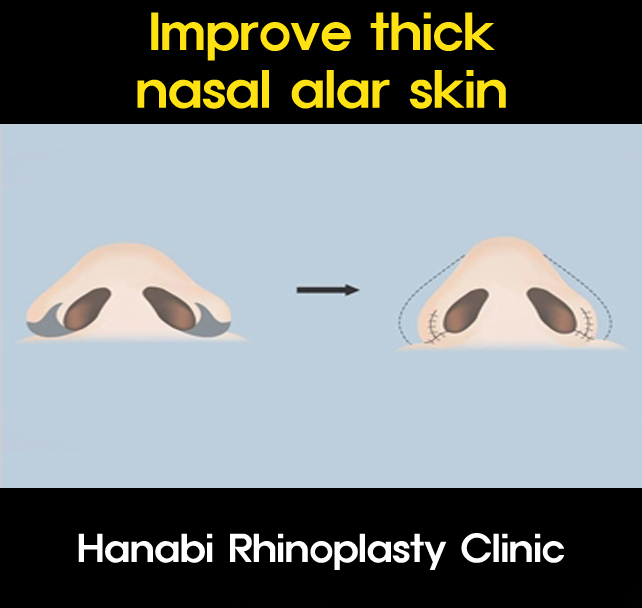 Best nose job clinic in Korea: Hanabi's alar base reduction