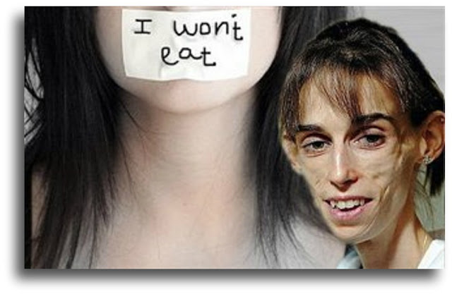 WHBC-GR: Πέθανε μετά από 16 χρόνια ανορεξίας η Kate Chilver