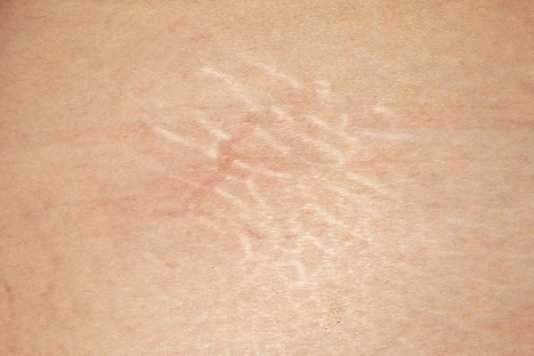 Trucs et remèdes grand mére pour atténuer les Vergetures - Conseils ...