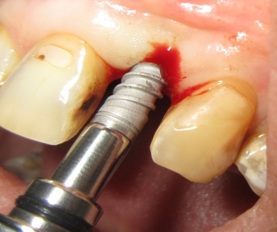 Dental Implants From Canada: FLAPLESS DENTAL IMPLANT PLACEMENT IN INDIA