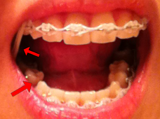 Rubber band | 966 Days of Braces