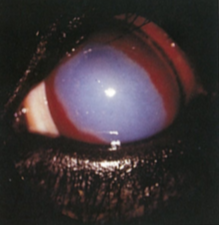 Eye Opener: Pathology - Common diseases