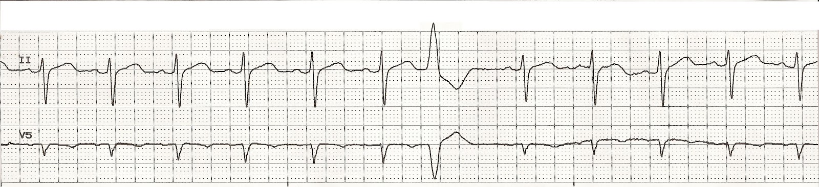 EKG Rhythm Strip Quiz 49