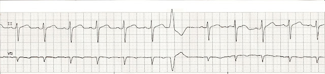 EKG Rhythm Strip Quiz 49