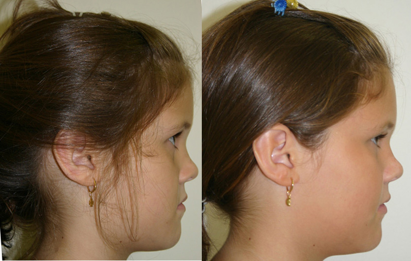 Clinica Denari - O Blog: TRATAMENTO DE PROGNATISMO