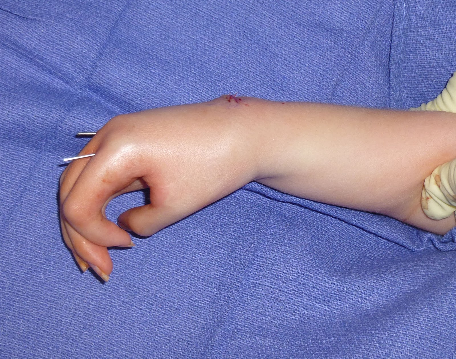 The Wrist in Arthrogryposis | Congenital Hand and Arm Differences ...