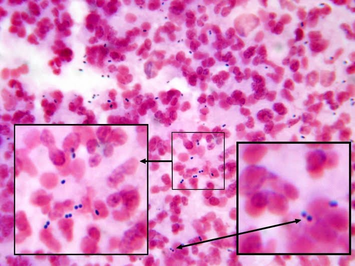 Tangents: Bacterial Meningitis