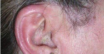 [Pediatric] Atlas of Otitis externa | Free Medical Atlas