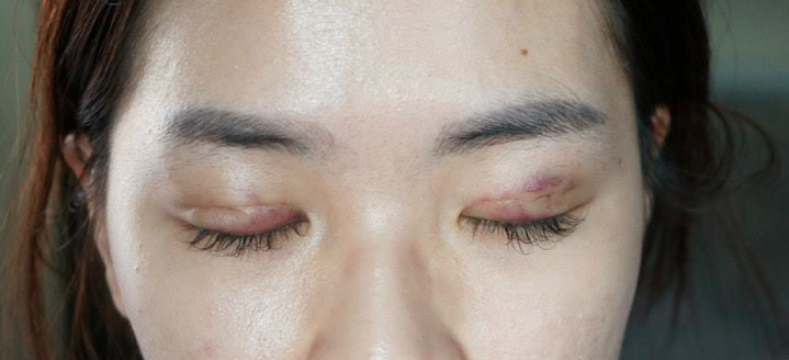 Karen Kho: 我的雙眼皮 (My Double Eyelid Stitching Experience)
