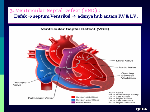 SISTEM KARDIOVASKULER 1 & 2 : Congenital Heart Disease (CHD)