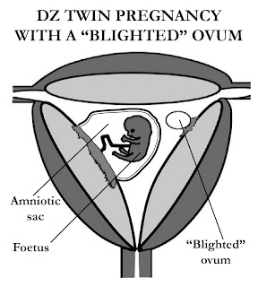 Womb Twin Survivors: Signs of a twin conception: (6) the blighted ovum