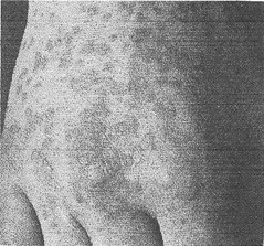 PUBLIC HEALTH: VERRUCA A SKIN DISEASE