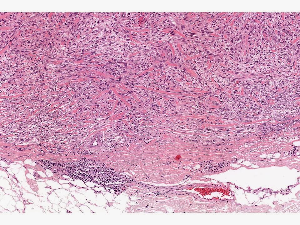 Dermpath Made Simple - Neoplastic: Atypical Fibroxanthoma