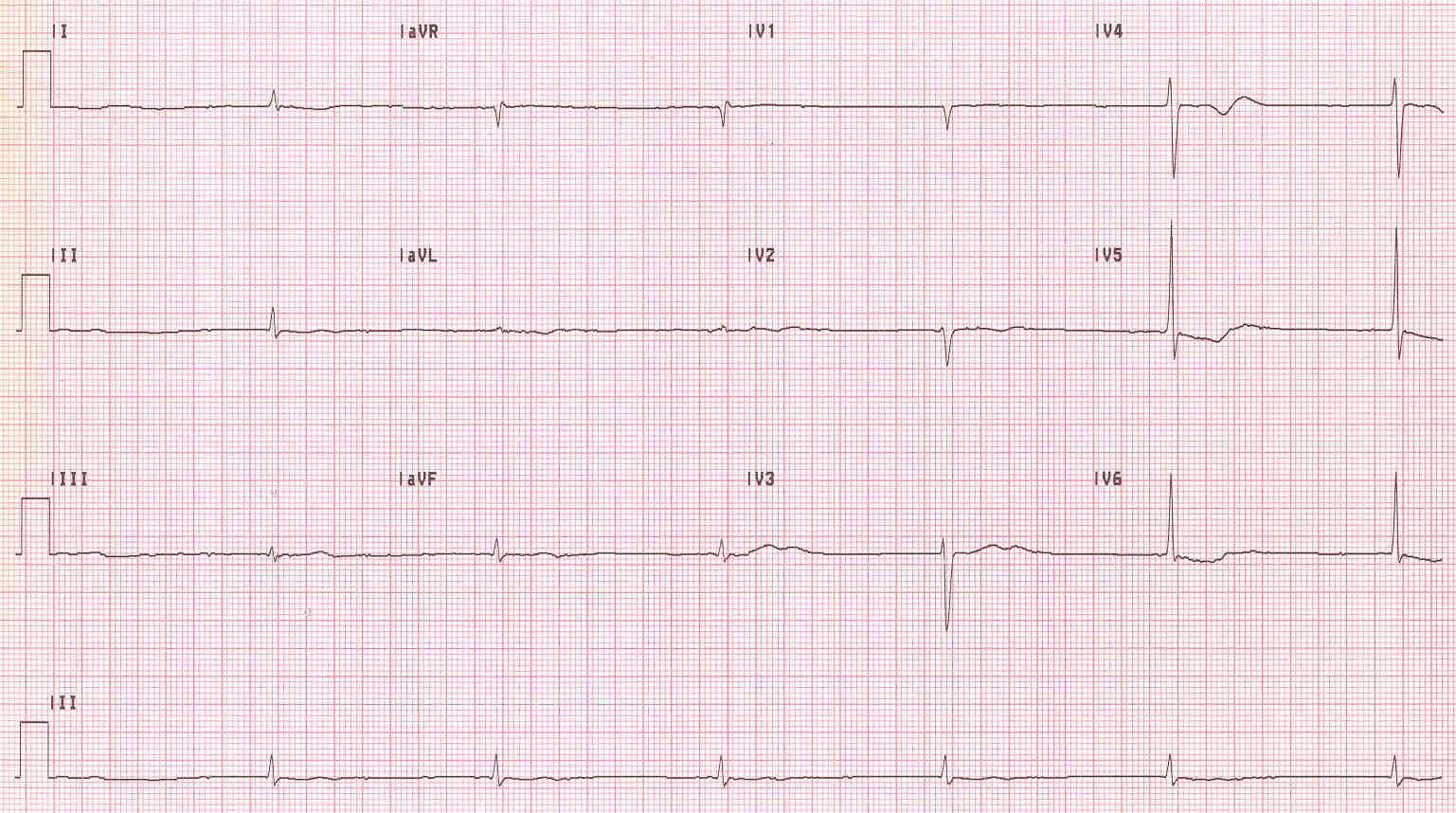 FIREFIGHTER/PARAMEDIC STORIES: Heart Rhythms Part 3: Junctional Rhythms