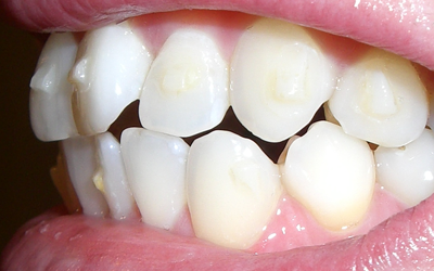 Sneek's Invisalign Treatment: Progress Weeks 19-20