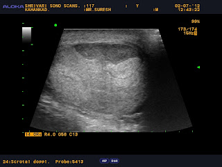 Shrivari Sono Scans: scrotal hrsg --reveals testicular fracture