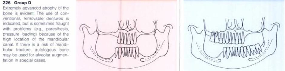 TRATAMIENTOS DENTALES: Aspectos Anátomicos del área para implante dental