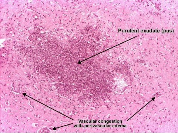 PATOLOGÍA HUMANA: PATRONES MORFOLÓGICOS DE LA INFLAMACIÓN AGUDA