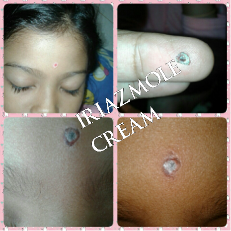 DAFFA IDEAL ENTERPRISE: CARA BETUL APPLY IRIAZ MOLE CREAM