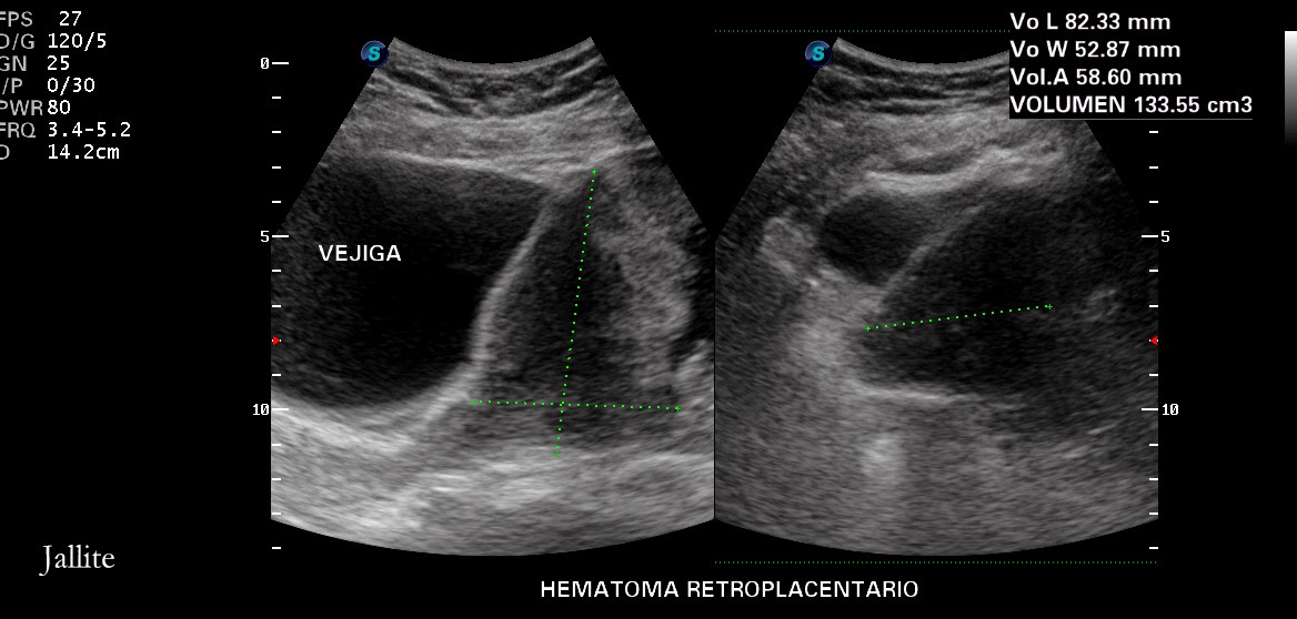 Placenta Previa & Hematoma Retroplacentario