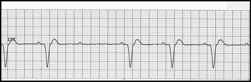 Various 2nd Degree Heart Block Type II