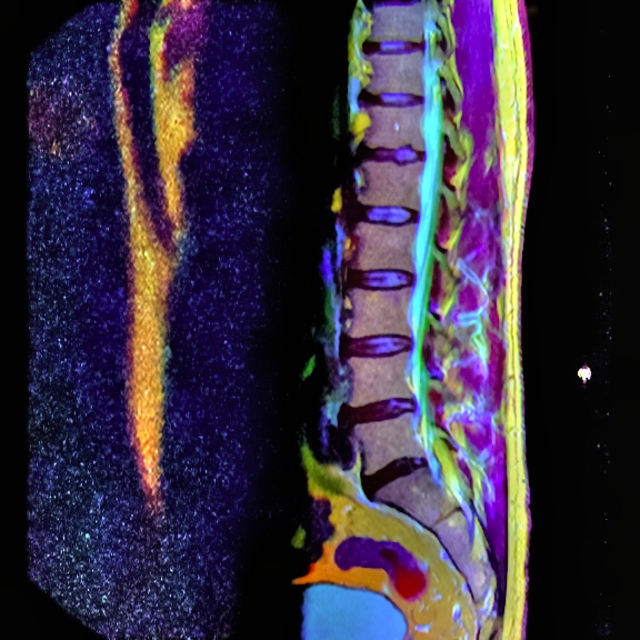 Nevit's blog: Color MRI of the Lumbar vertebrae