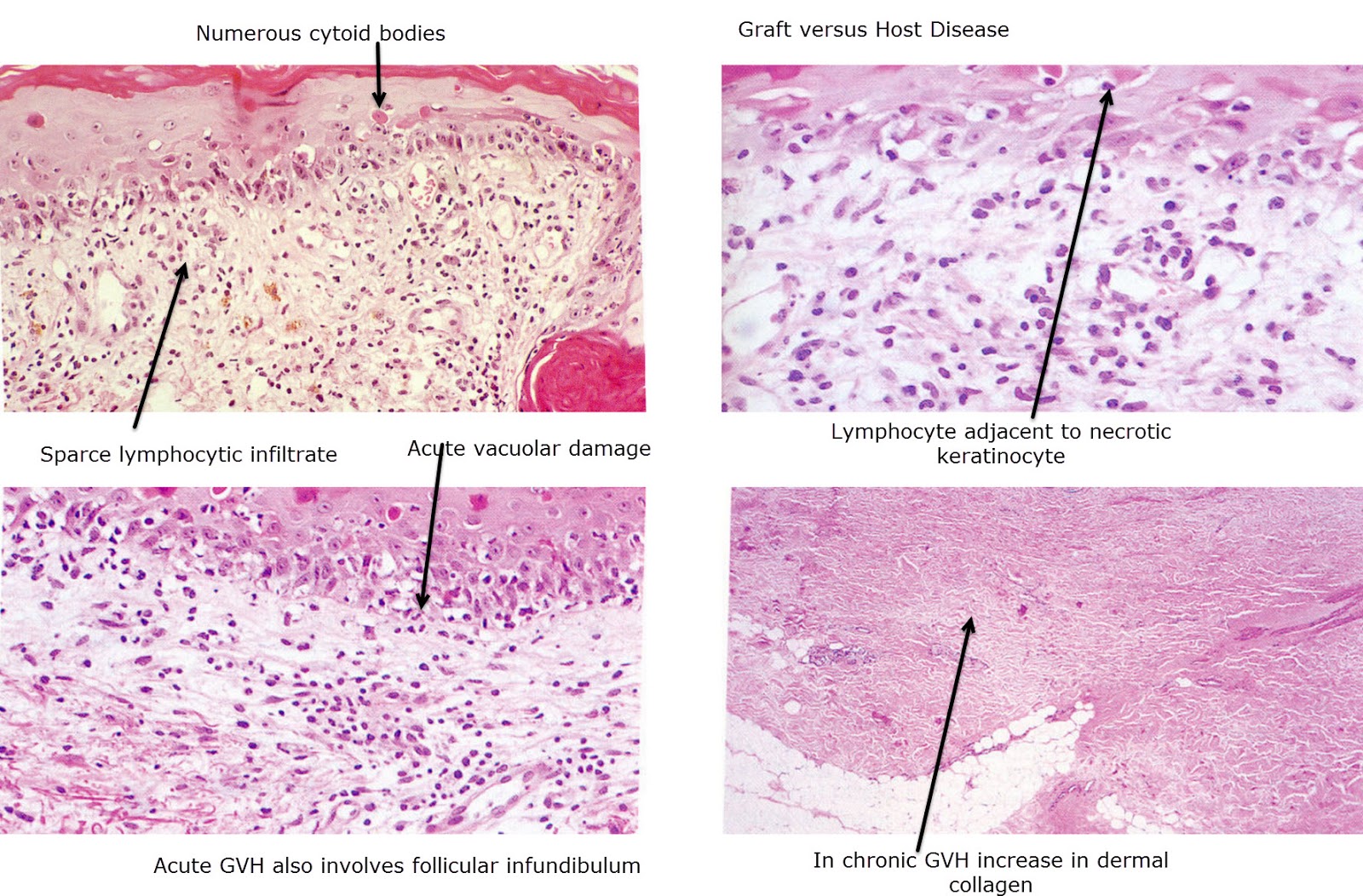 Dermatopathology Made Simple - Inflammatory: Interface - Vacuolar ...