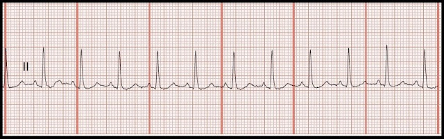 EKG Rhythm Strip Quiz 196