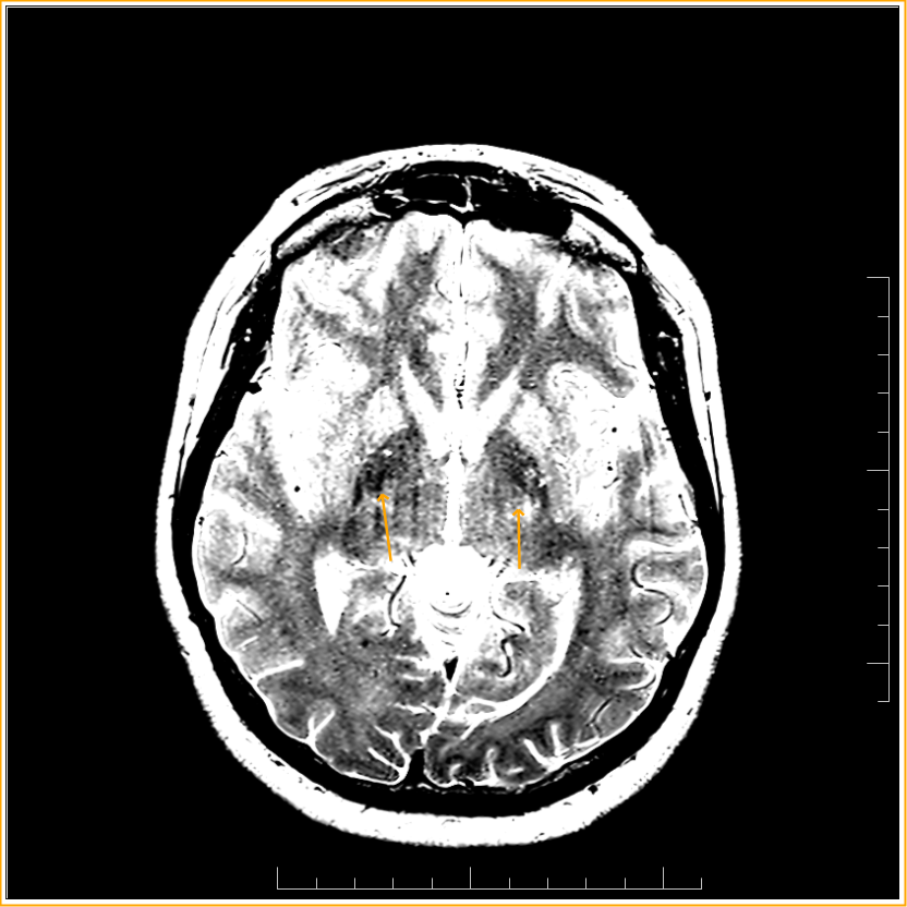 Mitochondrial protein-associated neurodegeneration (MPAN): MRI - Sumer ...