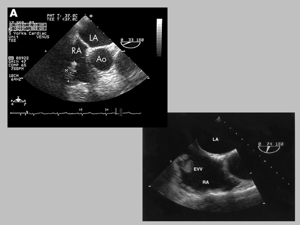 The Pump and the Tubes: Eustachian Valve