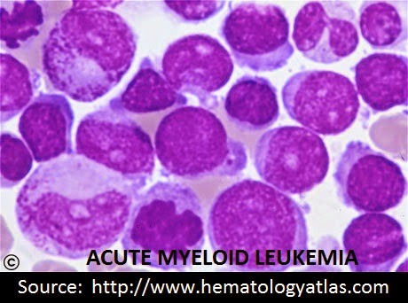Lab Atlas: Acute Myeloid Leukemia
