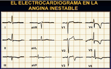 electrocardiograma angina inestable