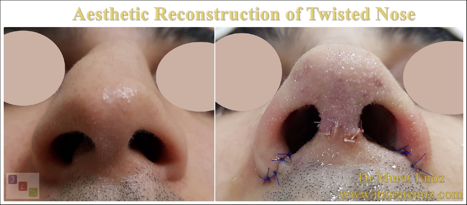 Aesthetic Reconstruction of Twisted Nose, Crooked Nose, Deviated Nose