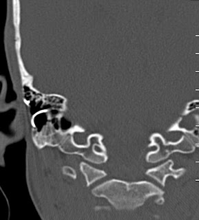 Cochlear implants and the Radiologist - Sumer's Radiology Blog