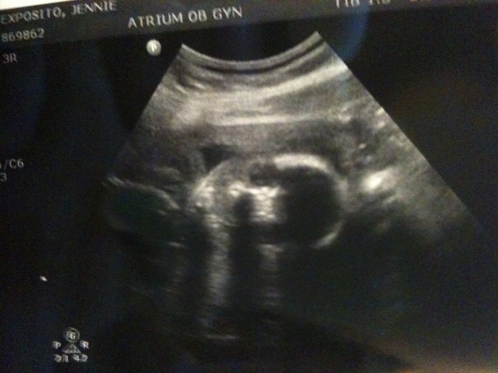 My Narrow Path: 22 Week Ultrasound