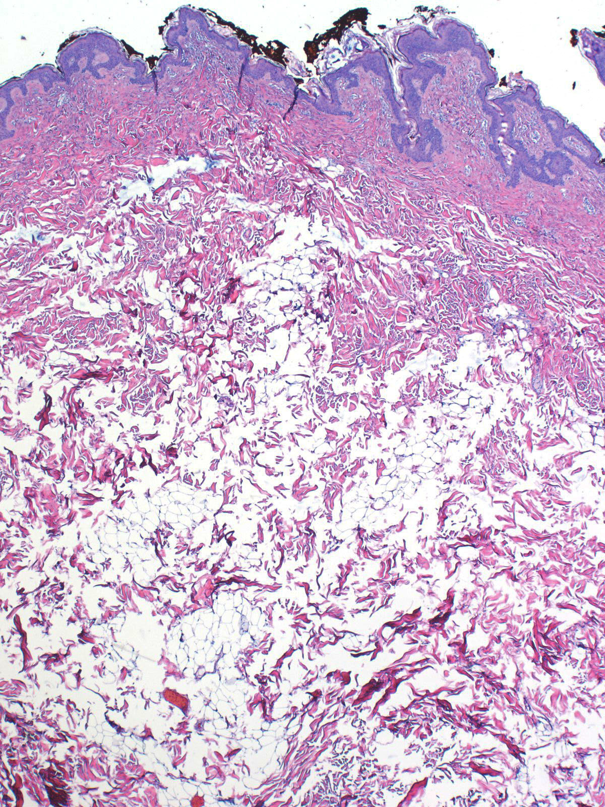 VIRTUAL GRAND ROUNDS IN DERMATOLOGY 2.0: Nevus Lipomatosus Superficialis