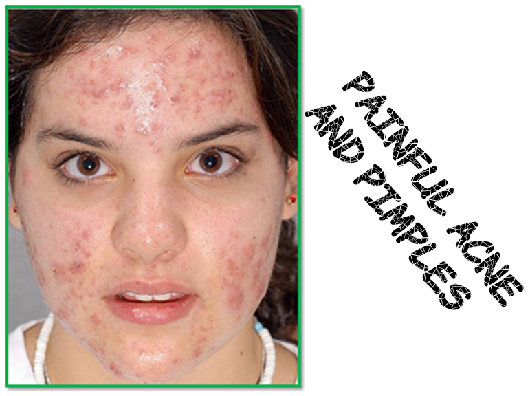 Painful Pimple and Acne Treatment ~ Get Rid of Acne in Just 1 Week