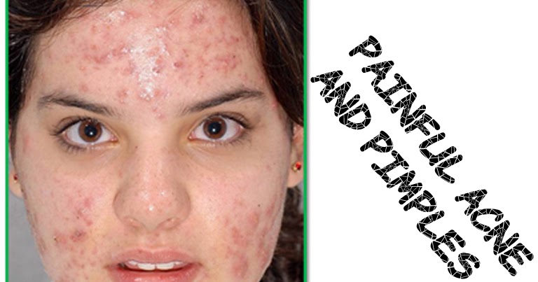 Painful Pimple and Acne Treatment ~ Get Rid of Acne in Just 1 Week