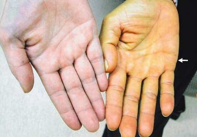 Causes Symptoms and Treatment of Jaundice Yellow Skin | Education and ...