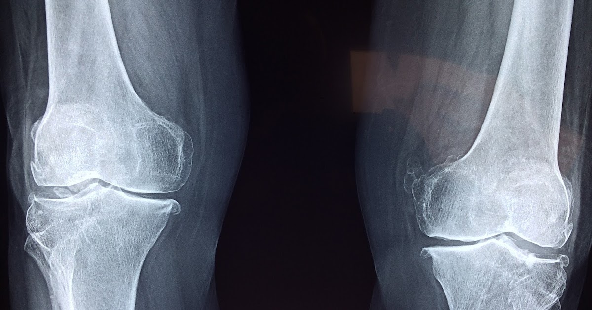 Huesos, Calcio y Vitamina D y K