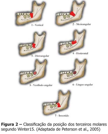 DúvidasOdonto: Classificação de Dentes Inclusos e Impactados
