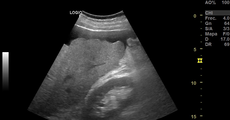 Ecografía en Atención Primaria: ASCITIS