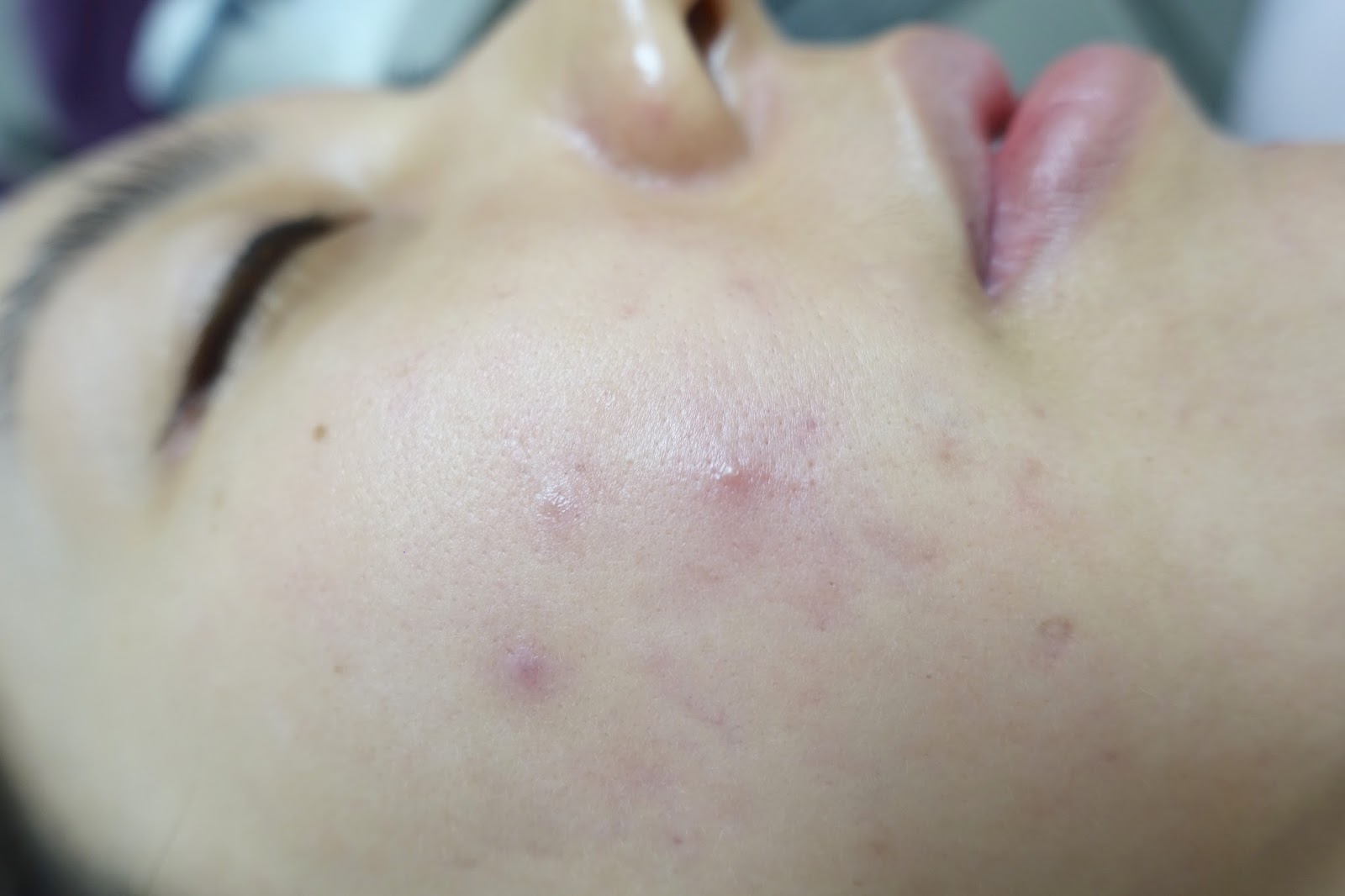 Chloe WL: Journey to acne-free skin with Face On Clinic