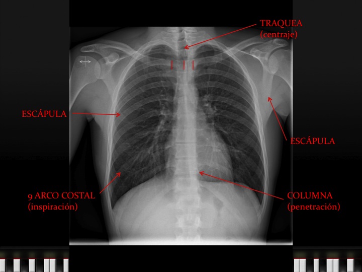 RADIOLOGIA LLEIDA: RADIOGRAFIA DE TORAX (II). Anatomía y valoración ...