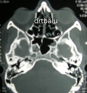 Tutorials in otolaryngology: Onodi cell